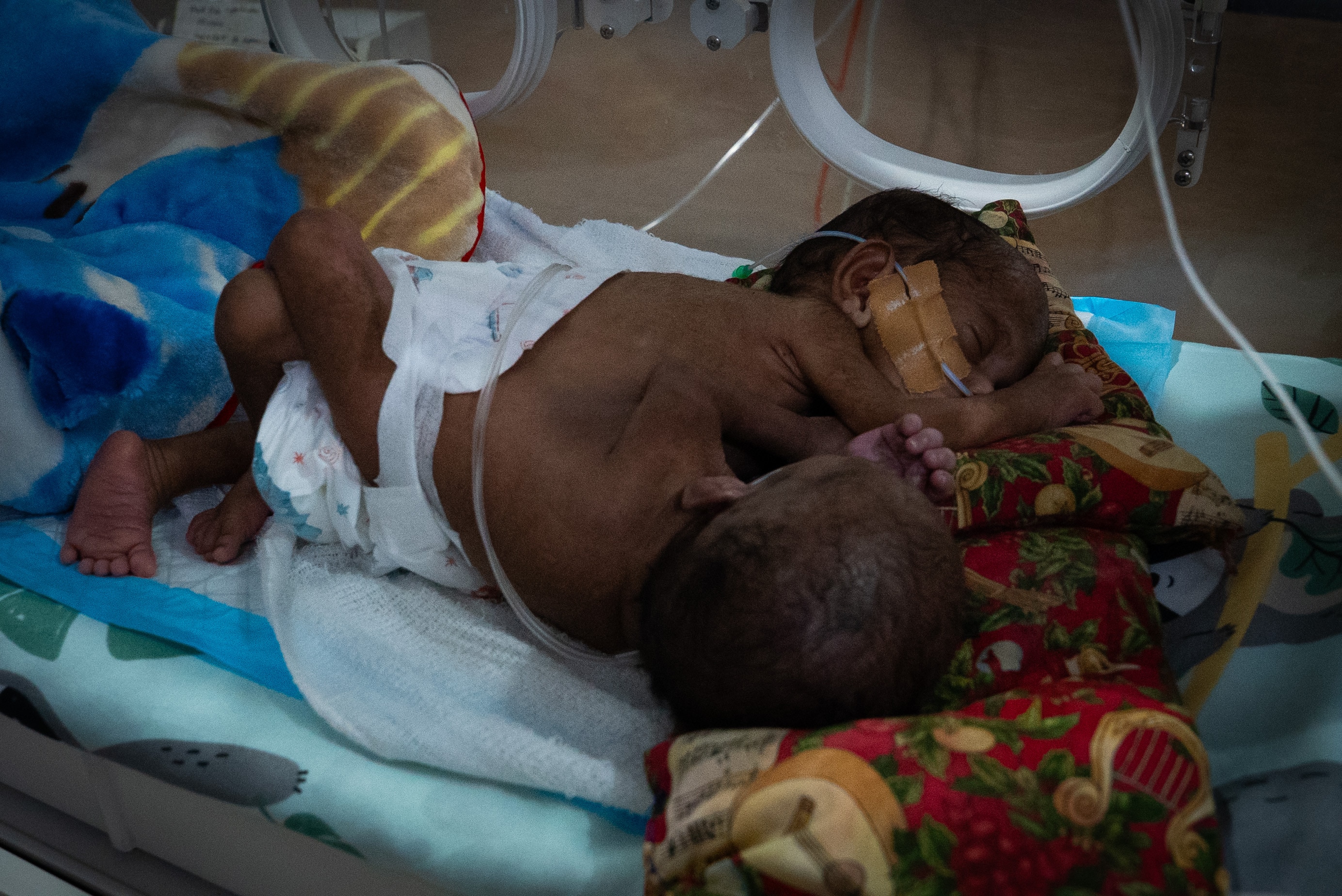 One of PNG's rare conjoined twins dies after urgent surgery in Sydney, brother survives - ABC News