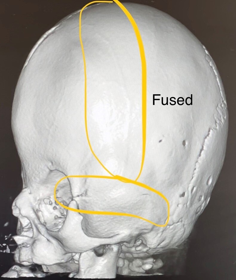 Surgeons will remove and then reconstruct a large part of Daisy's skull ...