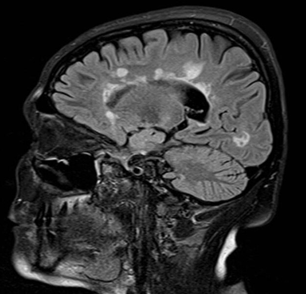 Perth researchers launch world first study into MS - ABC News