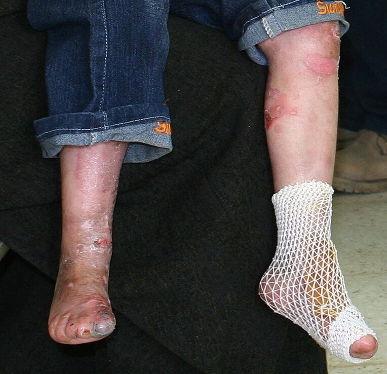 Gene therapy and grafts regrow skin of boy with incurable skin-peeling ...