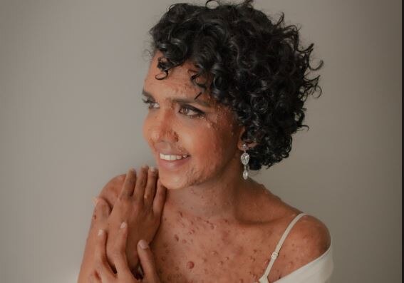 Janu was teased at school because of her tumours — three decades later ...