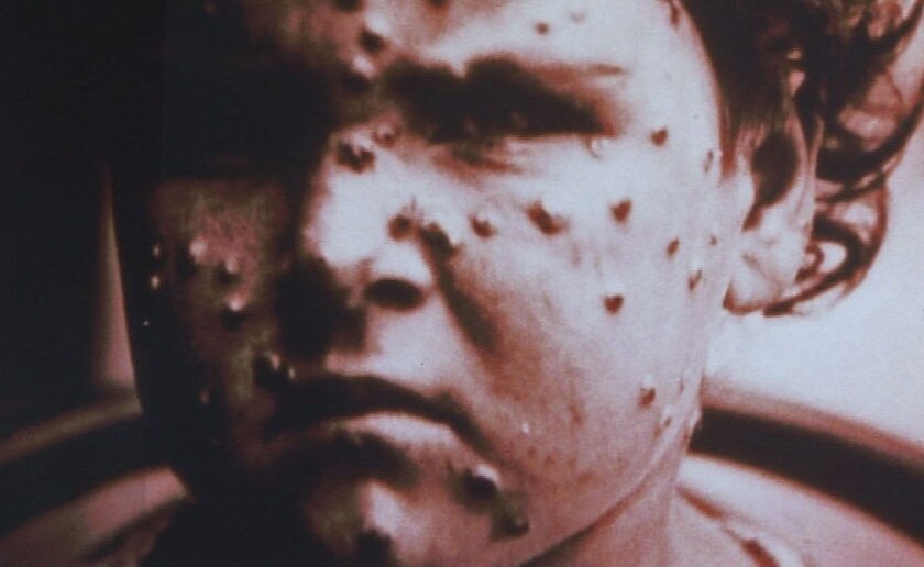 A small pox, a big debate - ABC News