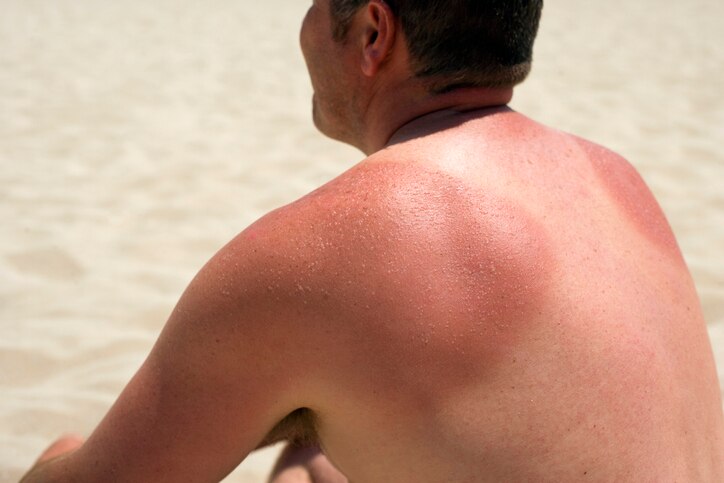 Making sure you don't sunburn - ABC listen