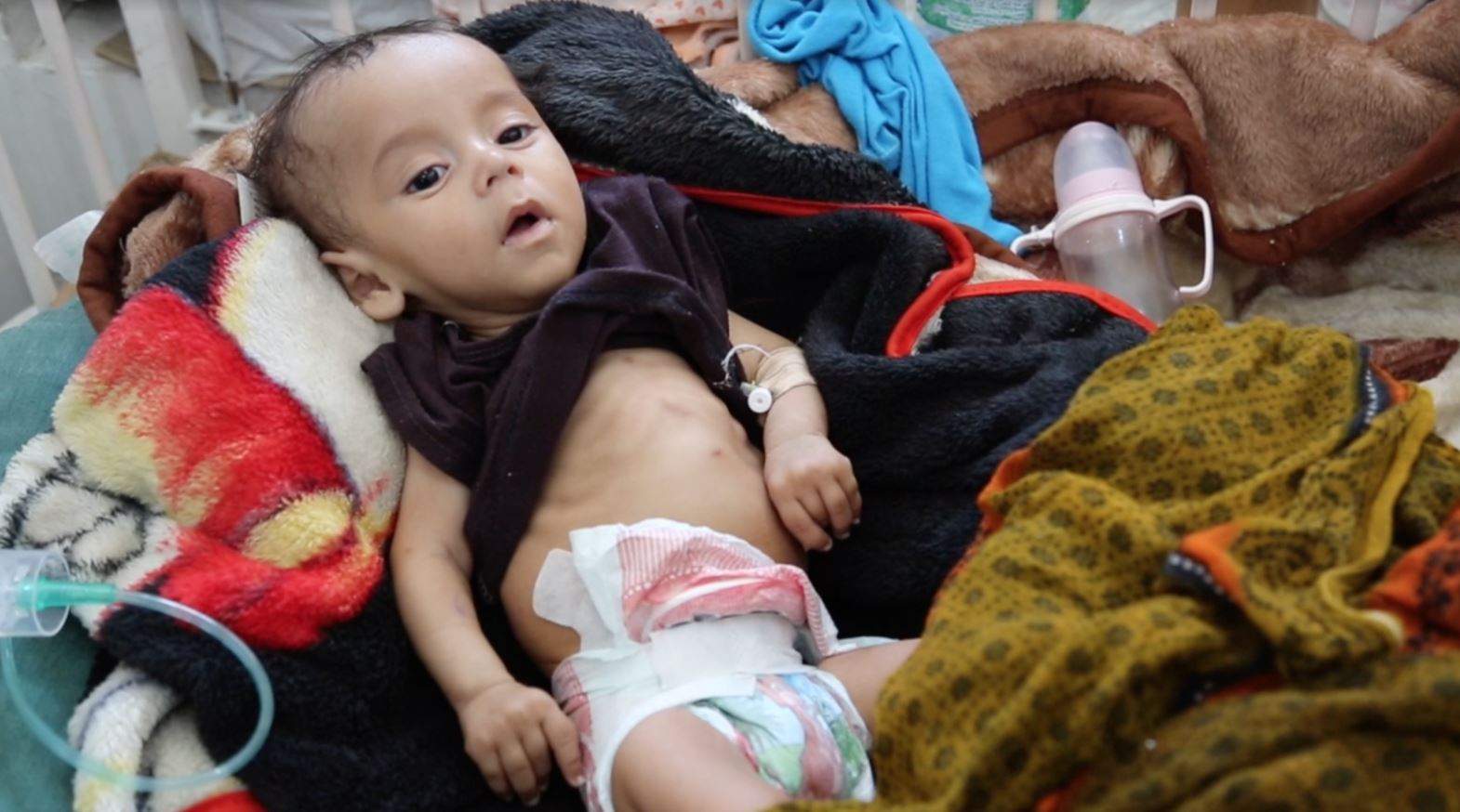 Yemen: Agencies call for aid as skeletal starving children on brink of ...