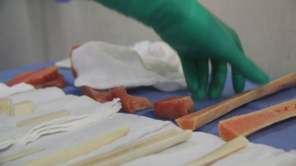 Bone banks constantly short of donors despite being the second most ...