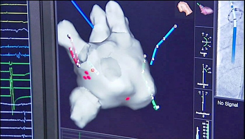 Doctors perform robotic heart surgery - ABC News