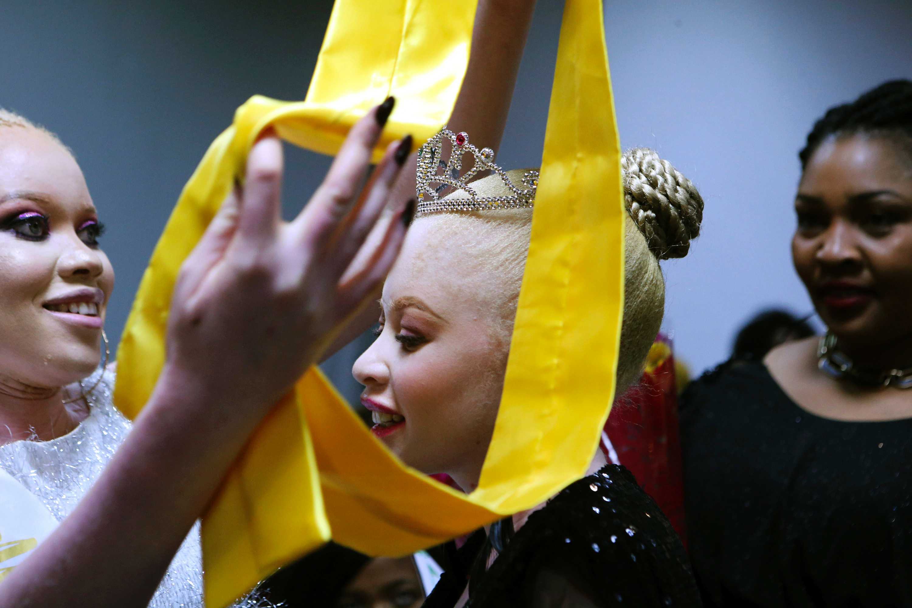 Zimbabwe's penchant for pageants gives albinos a chance to champion ...