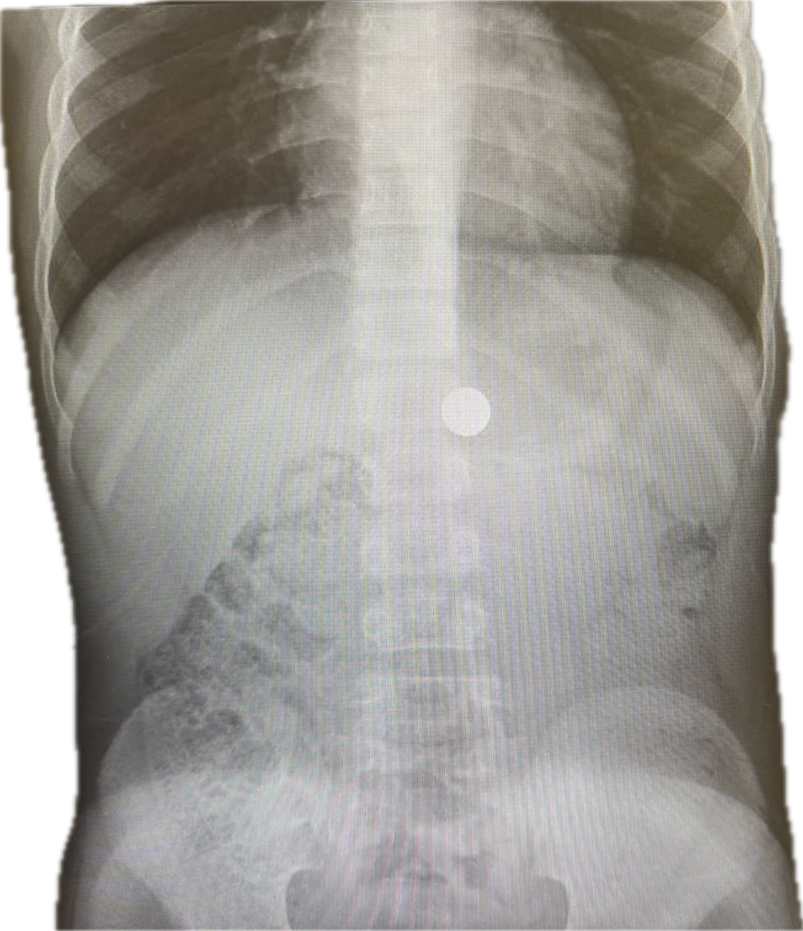 The top 10 things children get stuck up their nose, according to ...