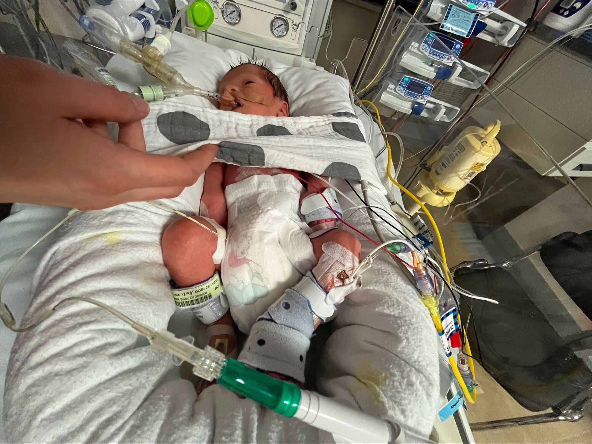 Brisbane baby who had surgery for gastroschisis days after being born ...