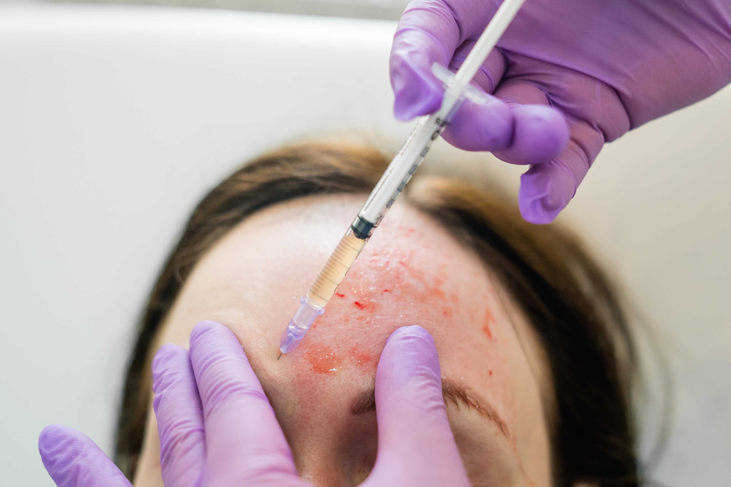 Vampire facials: Clinics report rising demand for injecting blood into ...