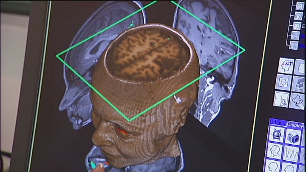 Scientists discover new brain cancer treatment - ABC News