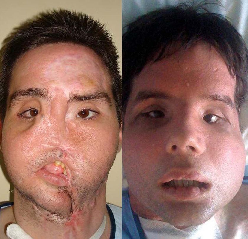Face transplant patient thanks doctors, donor - ABC News