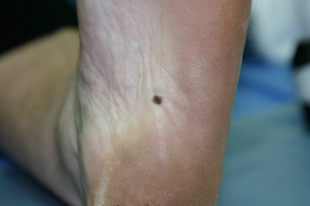 Malignant Melanoma Foot