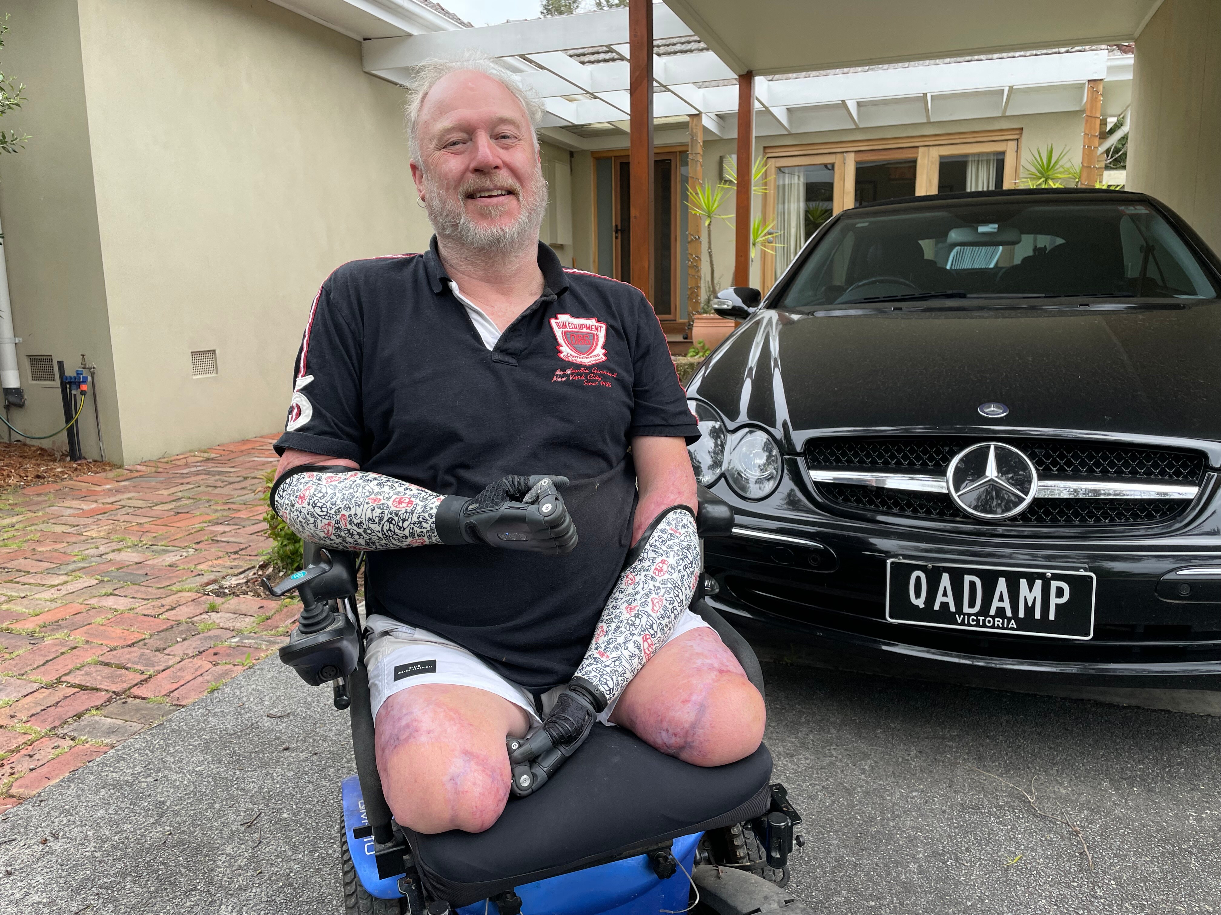 John lost all his limbs four years ago. Bionic devices allowed him to ...