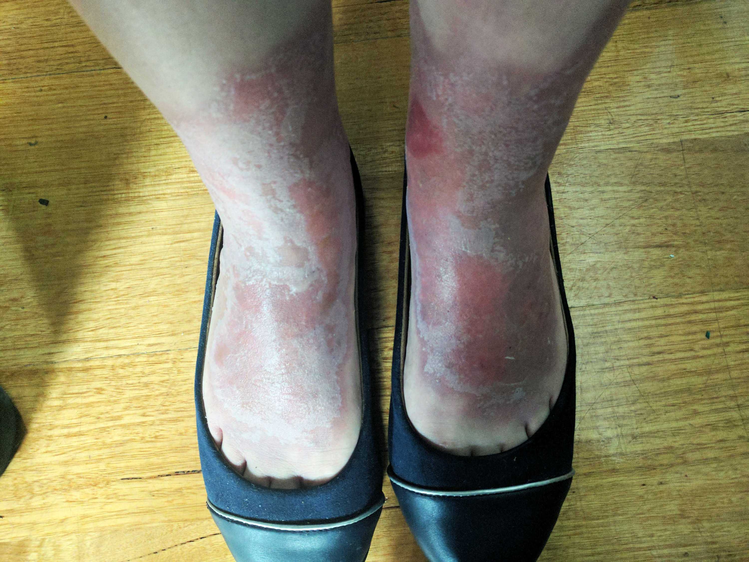 'Painful' sunscreen burn cases ignite call for review of product ...