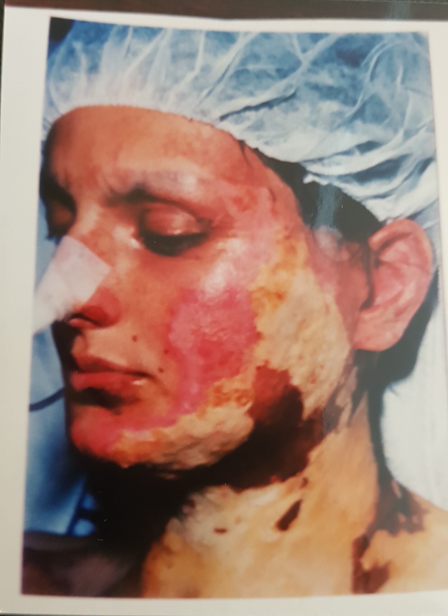 Reports of domestic violence burn injury cases likely 'tip of the ...