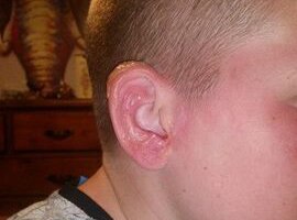 'Painful' sunscreen burn cases ignite call for review of product ...