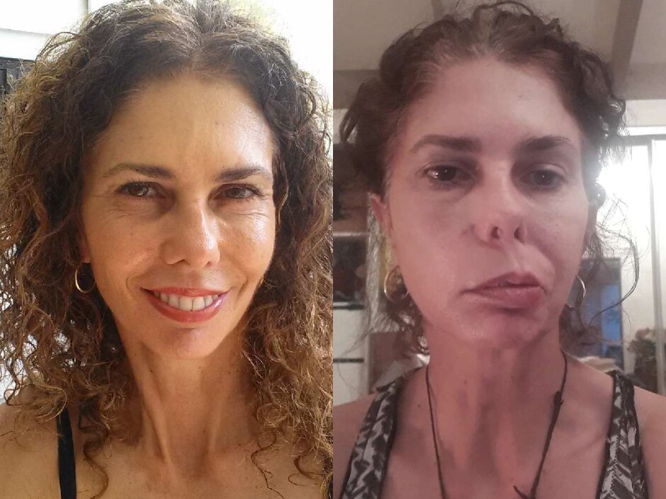 Woman's face paralysed after a tick burrowed in her ear - ABC News