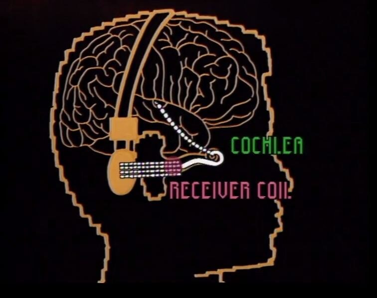 Video from the vault: the bionic ear - ABC News