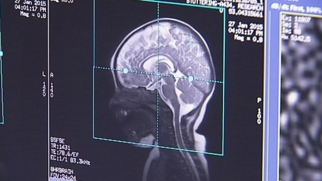 Researchers scan babies' brains in attempt to find cause of stuttering ...