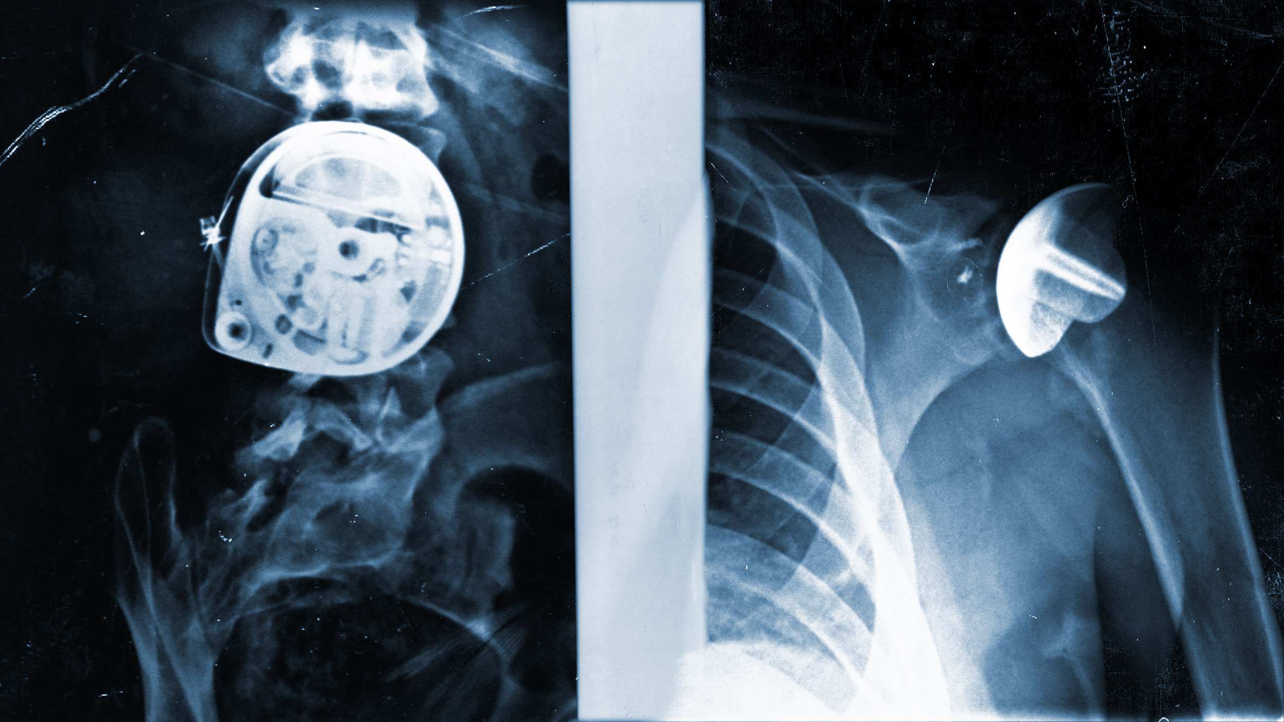 The Implant Files: The hidden human toll of lax controls on the booming ...