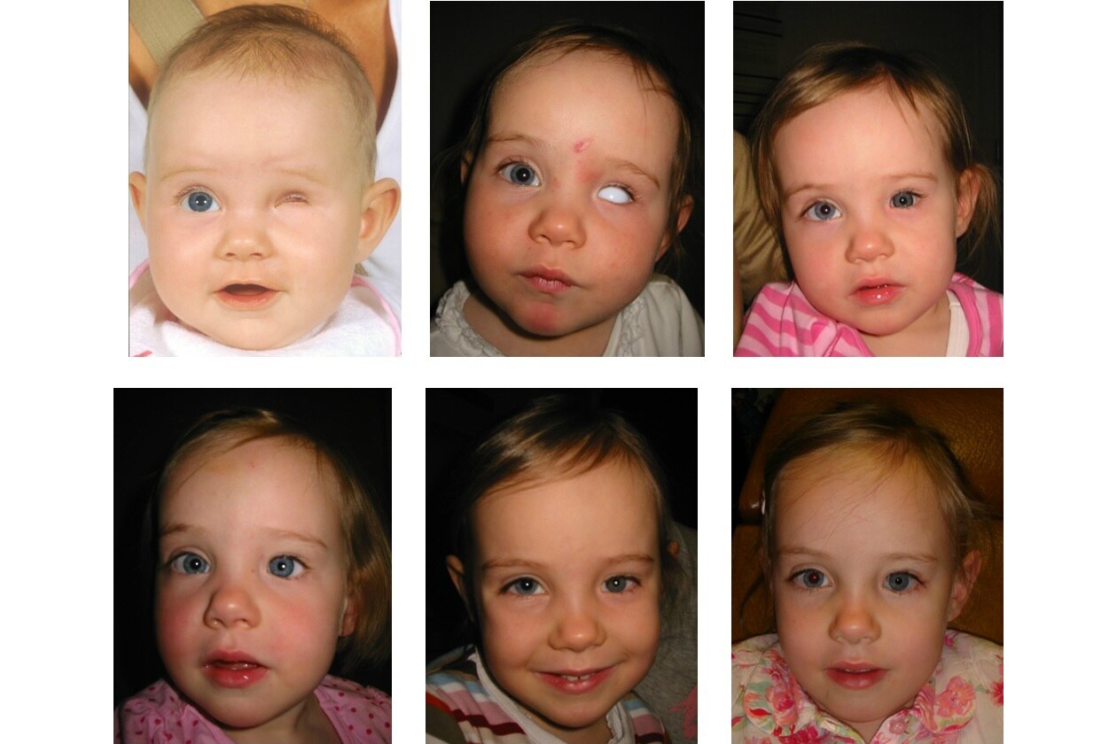 New techniques help genetically controlled eye conditions - ABC listen