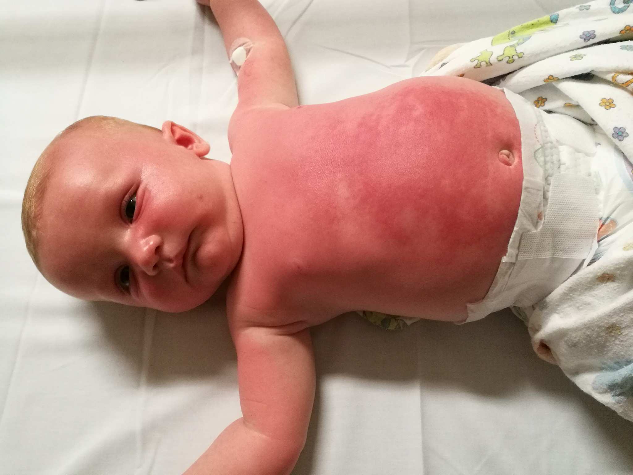Baby hospitalised after using Cancer Council Peppa Pig 50+ sunscreen ...