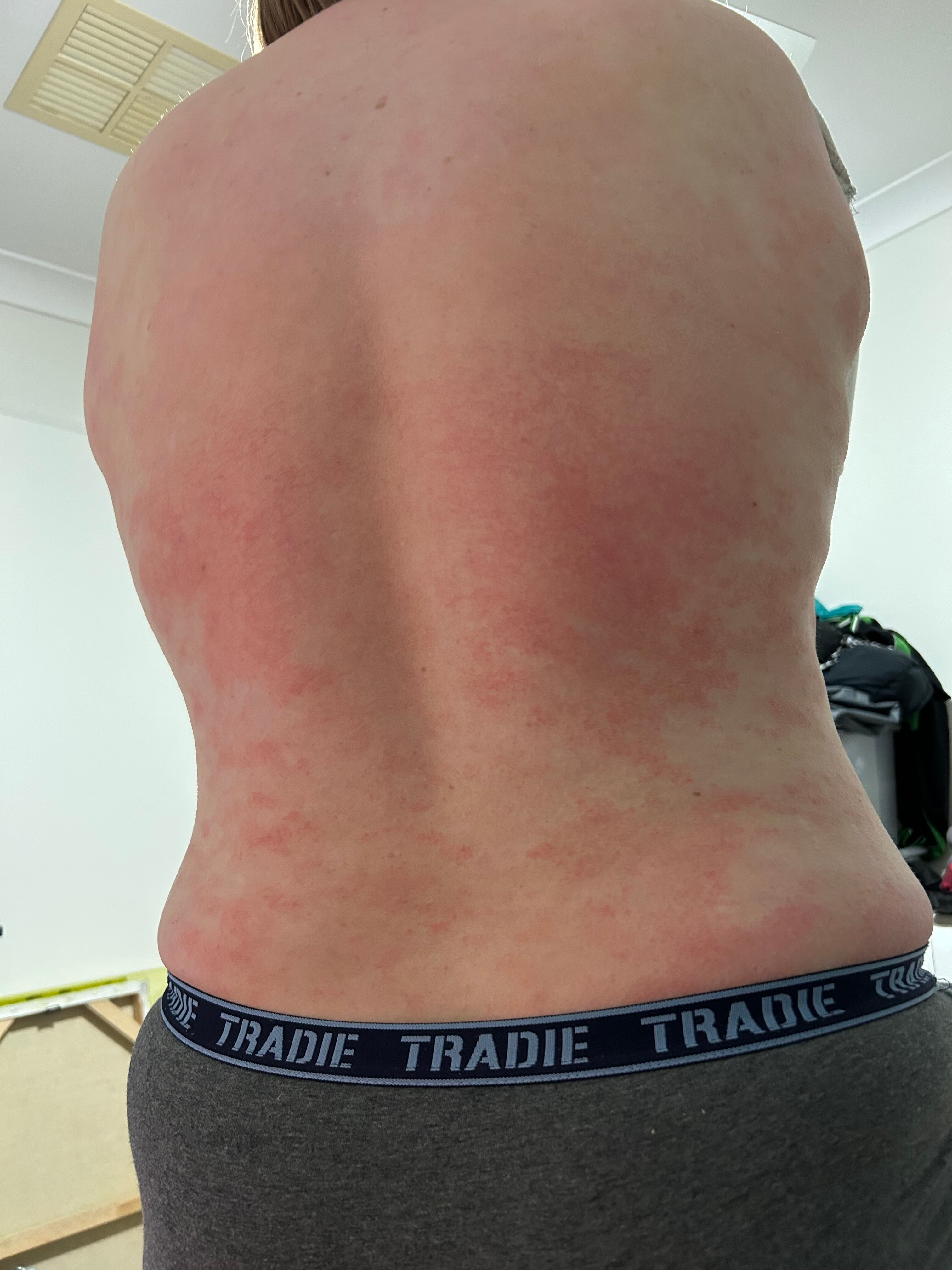 Eczema is debilitating, controlling and expensive and it could be worse ...