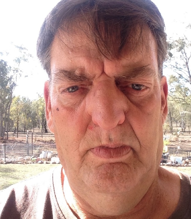 Concern grows over hernia mesh as more patients share post-surgery ...