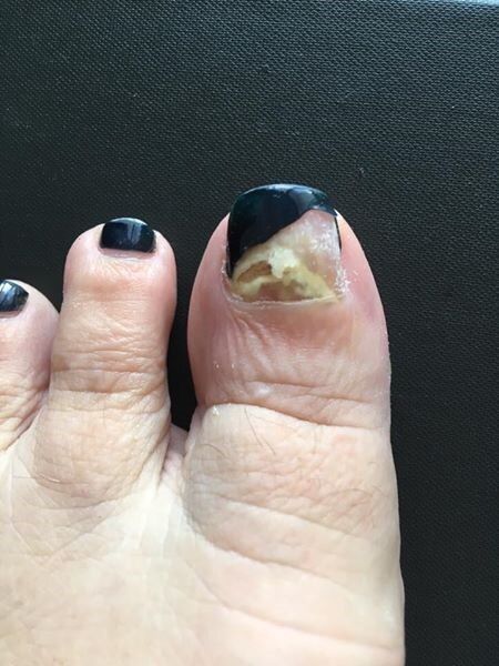 Pedicures and Fungal Infections. - ABC Darwin