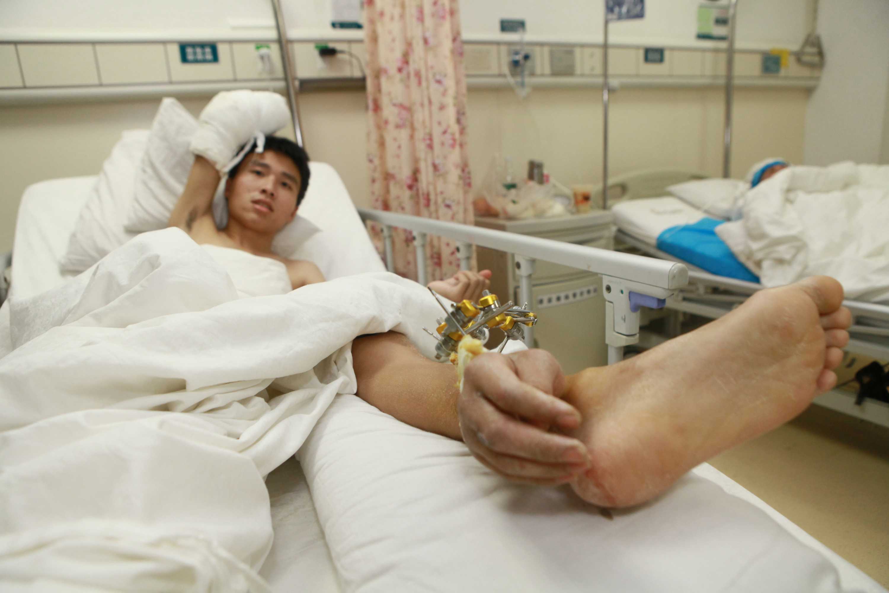 Chinese surgeons reattach a man's severed hand after keeping it alive ...