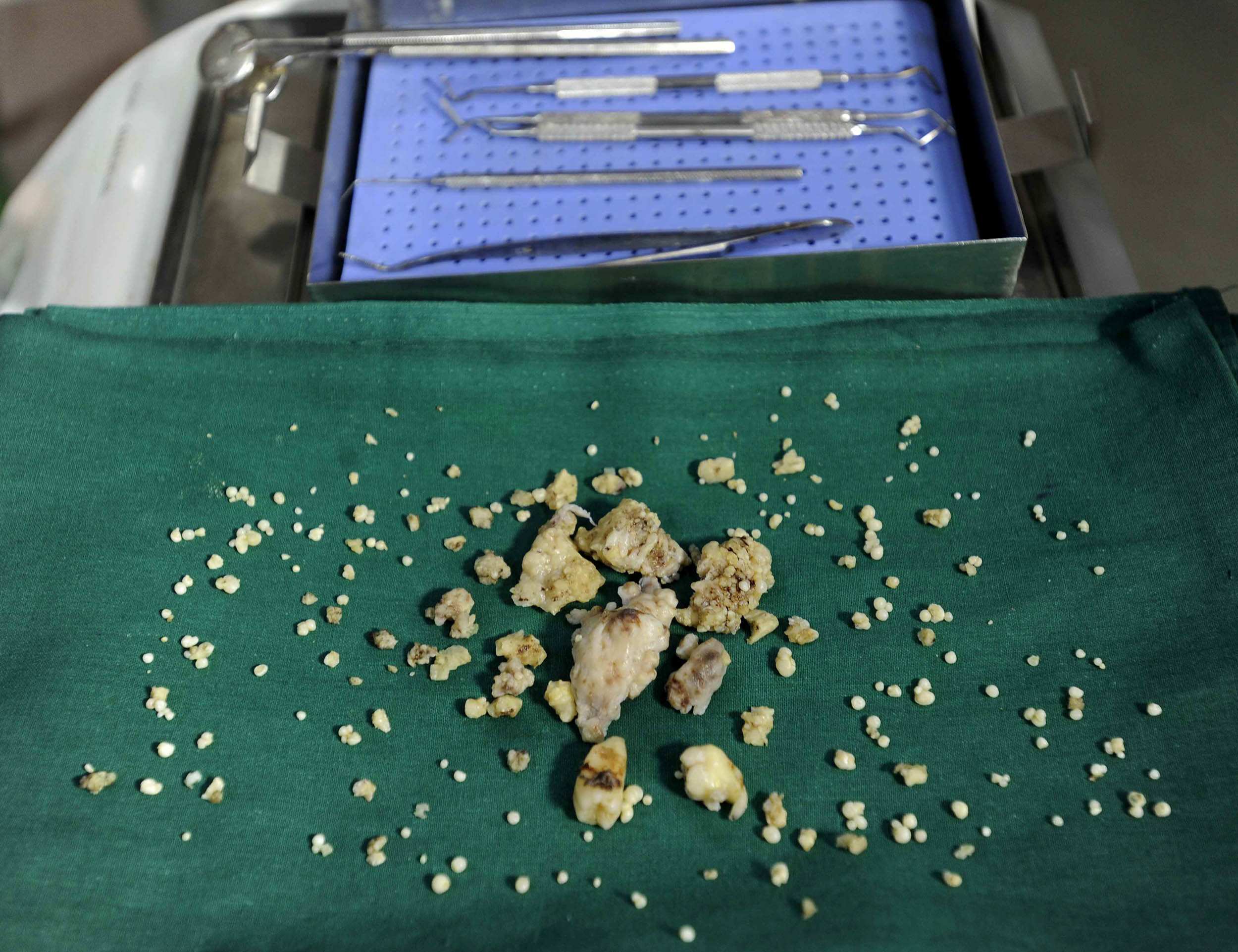 Surgeons remove 232 teeth from Indian teenager - ABC News