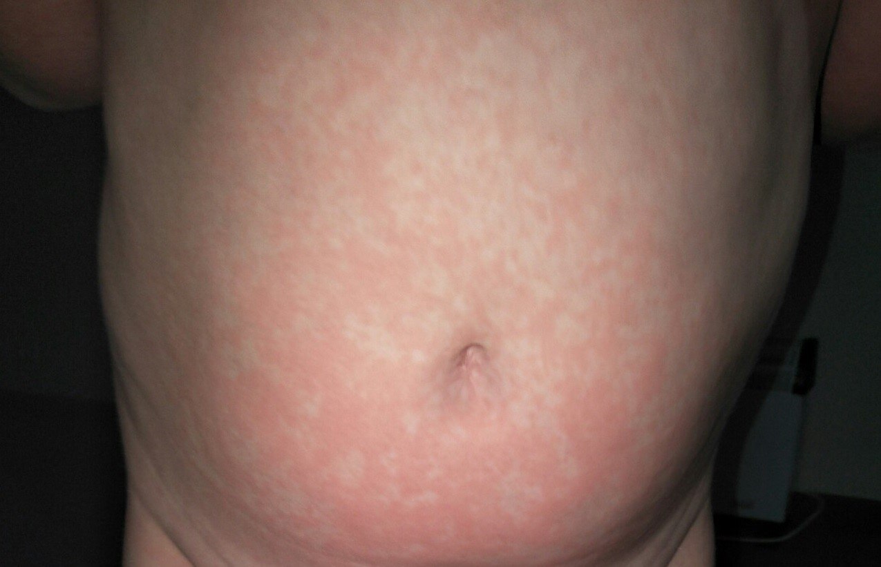 Mother of five-year-old boy with influenza-A 'didn't think flu could be ...