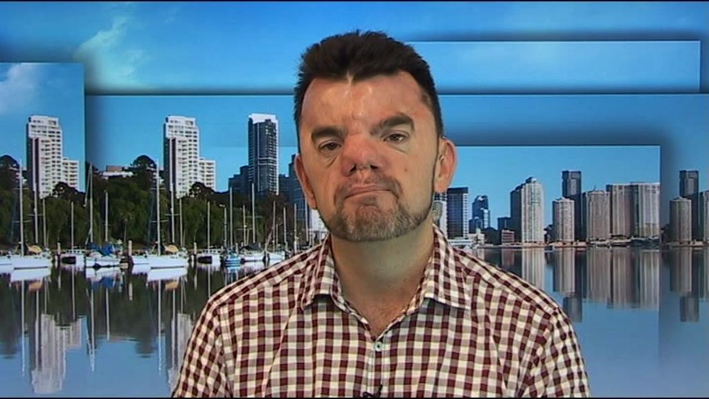 Robert Hoge, born with deformed legs and facial tumour, embraces ugly ...