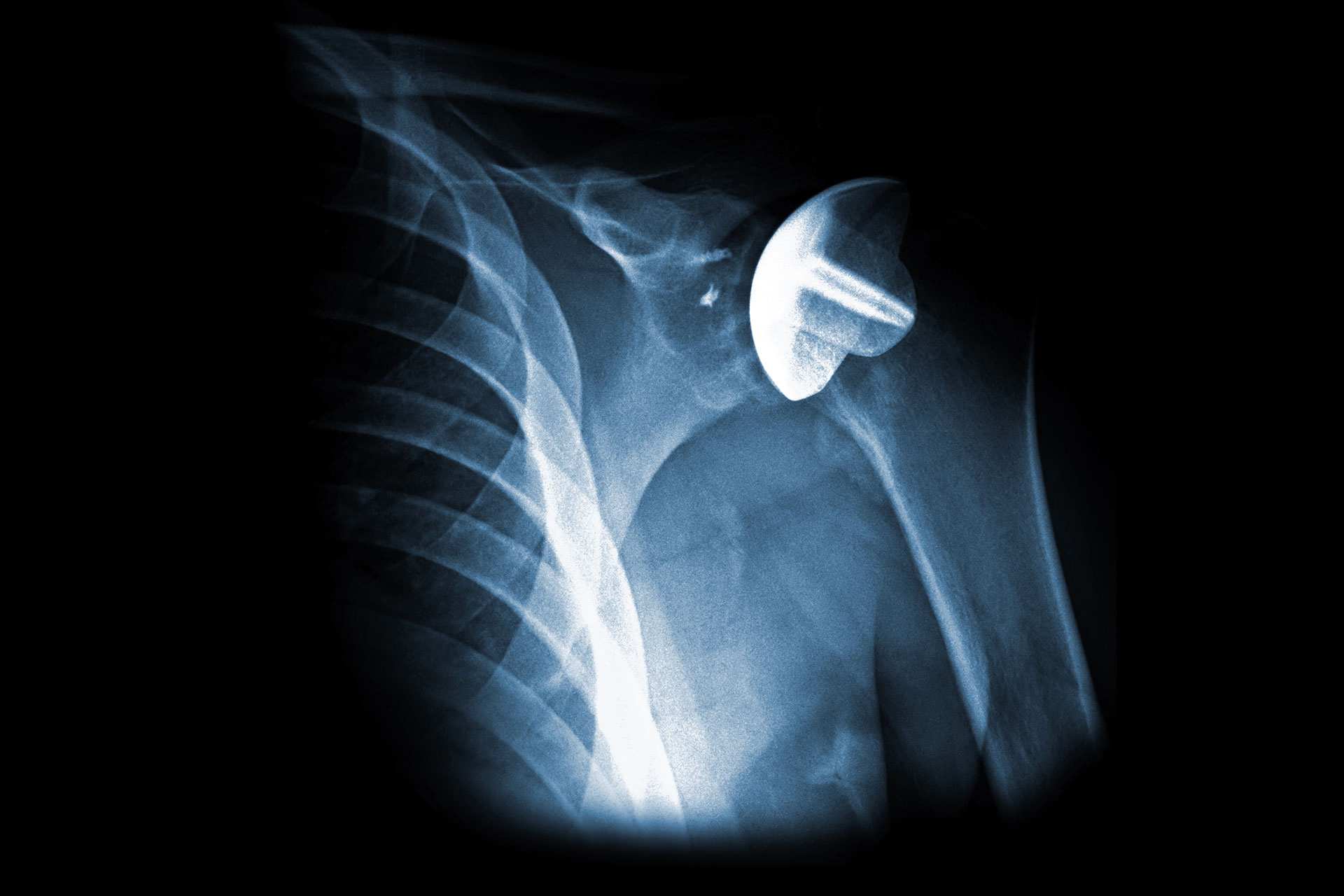 The Implant Files reveal TGA failures in medical device trial - ABC News