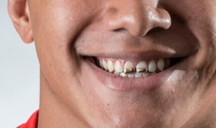 Gold teeth, a right of passage for many Tongans - ABC Pacific