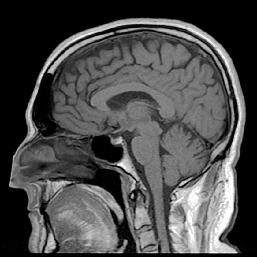 Australian study finds forever chemicals in human brain tissue - ABC listen