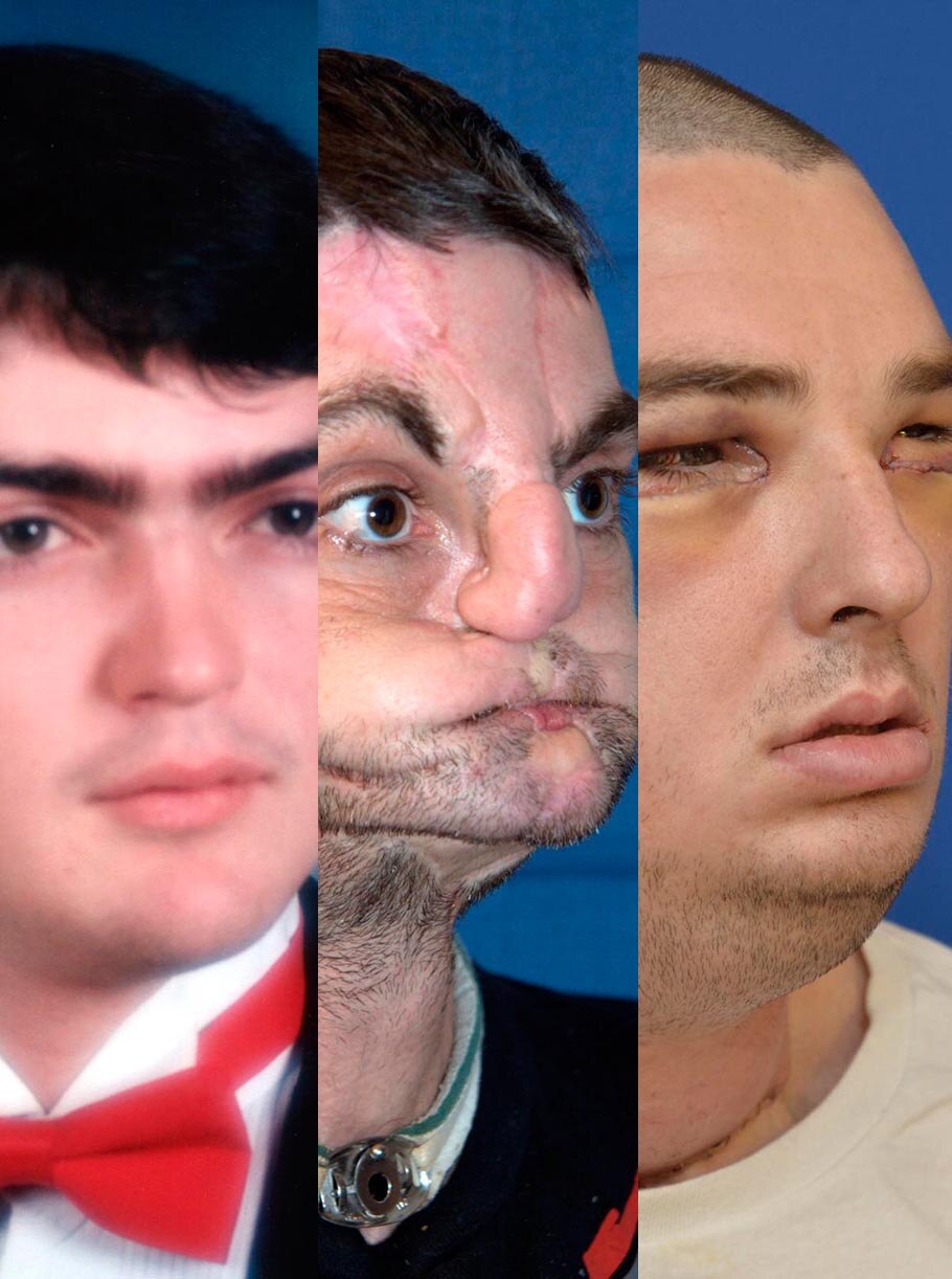 US face transplant offers hope for IED victims - ABC News