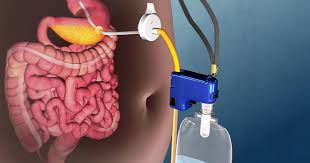 'Fat tap' device to help obesity fight - ABC Melbourne