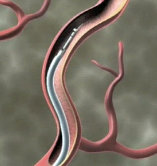 Micro-motor developed to treat strokes - ABC News