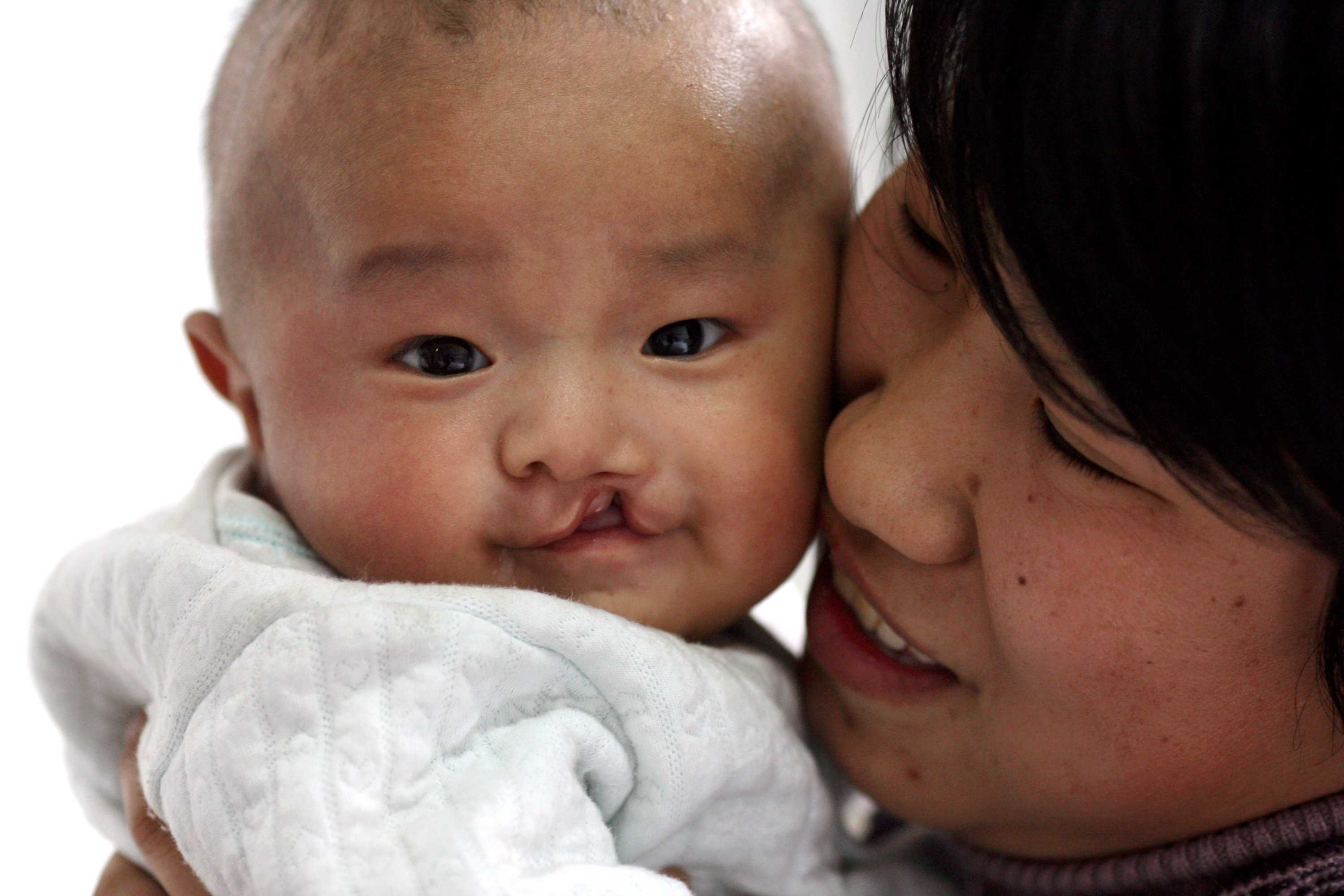 Cleft palate or lip is one of the most common birth defects worldwide ...