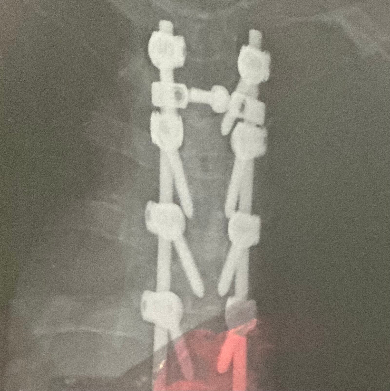 Bone banks constantly short of donors despite being the second most ...