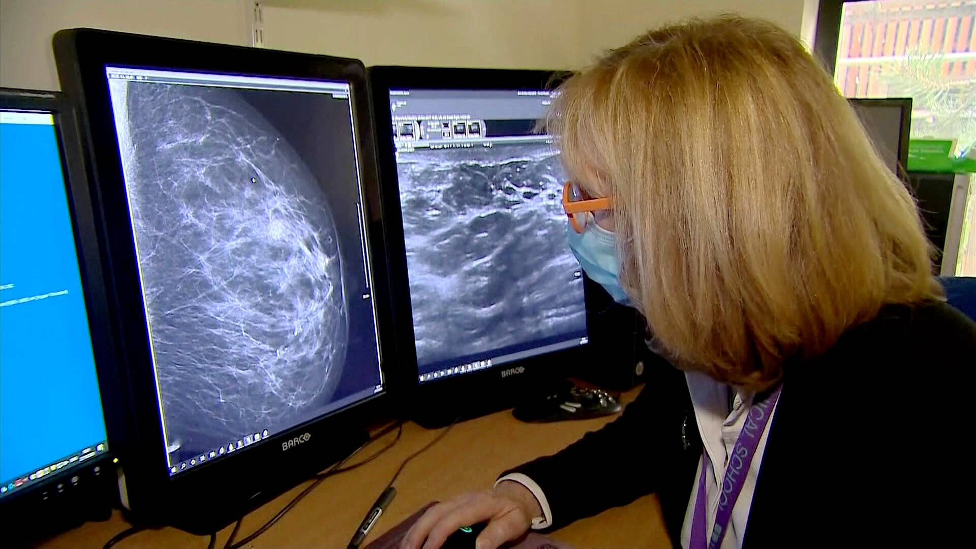 Breast screening results delayed in SA as mammogram provider seeks more ...