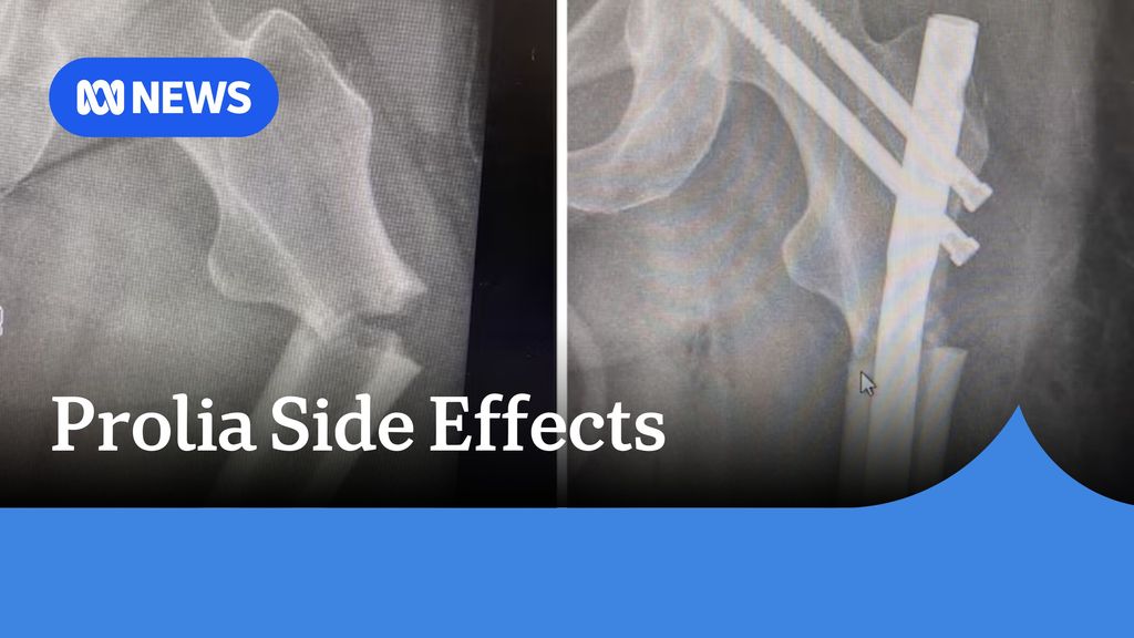 Patients not being warned about side effects of osteoporosis drug ...