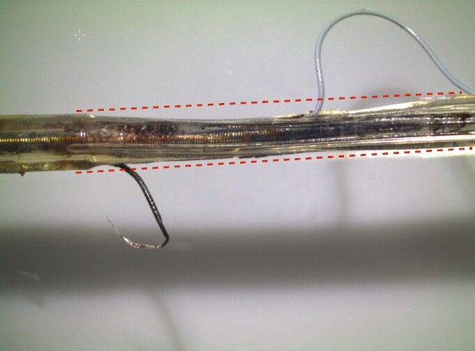 Pacemaker-defibrillator device shocks patient 60 times, but ...