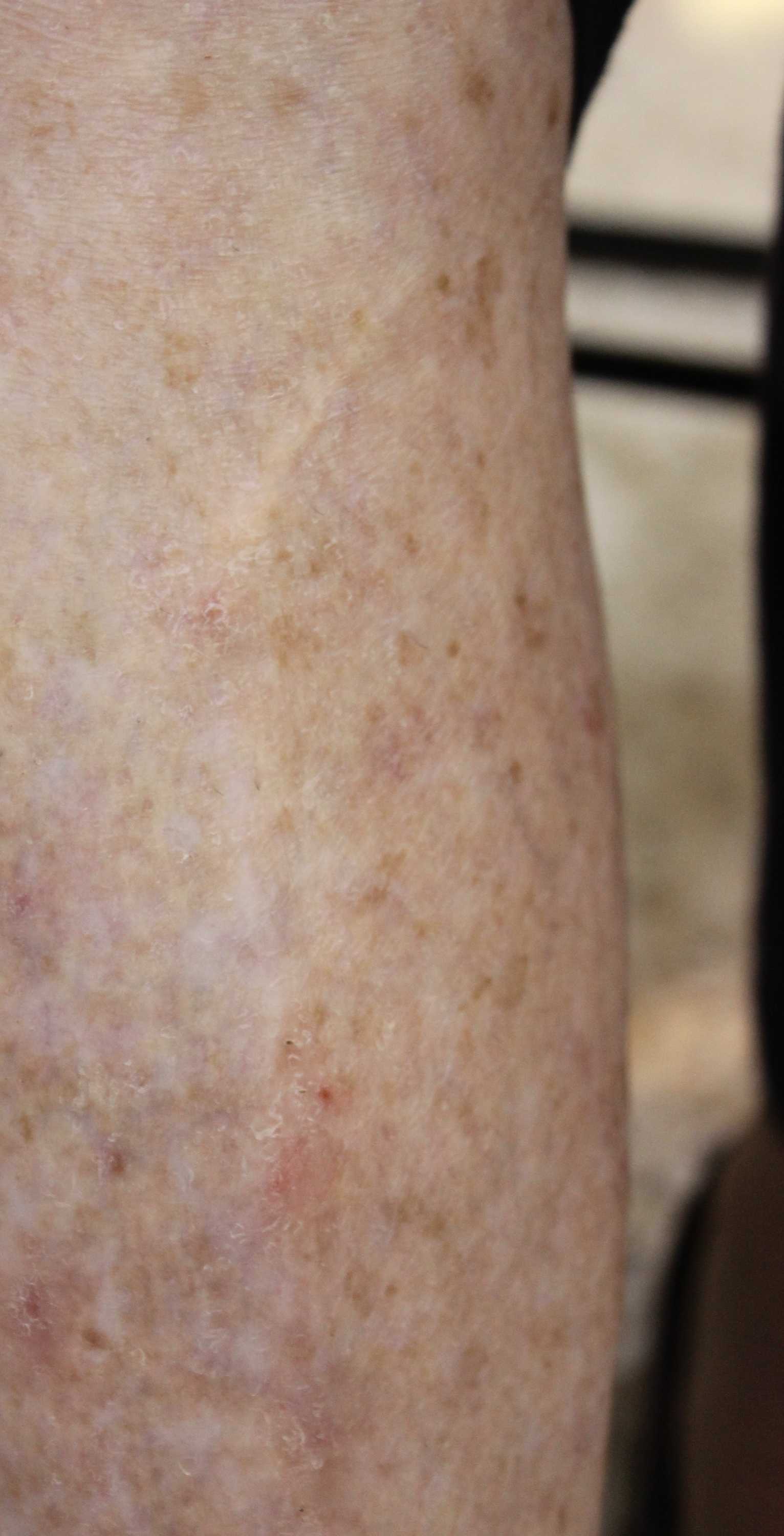 The Y shaped scar - ABC Brisbane