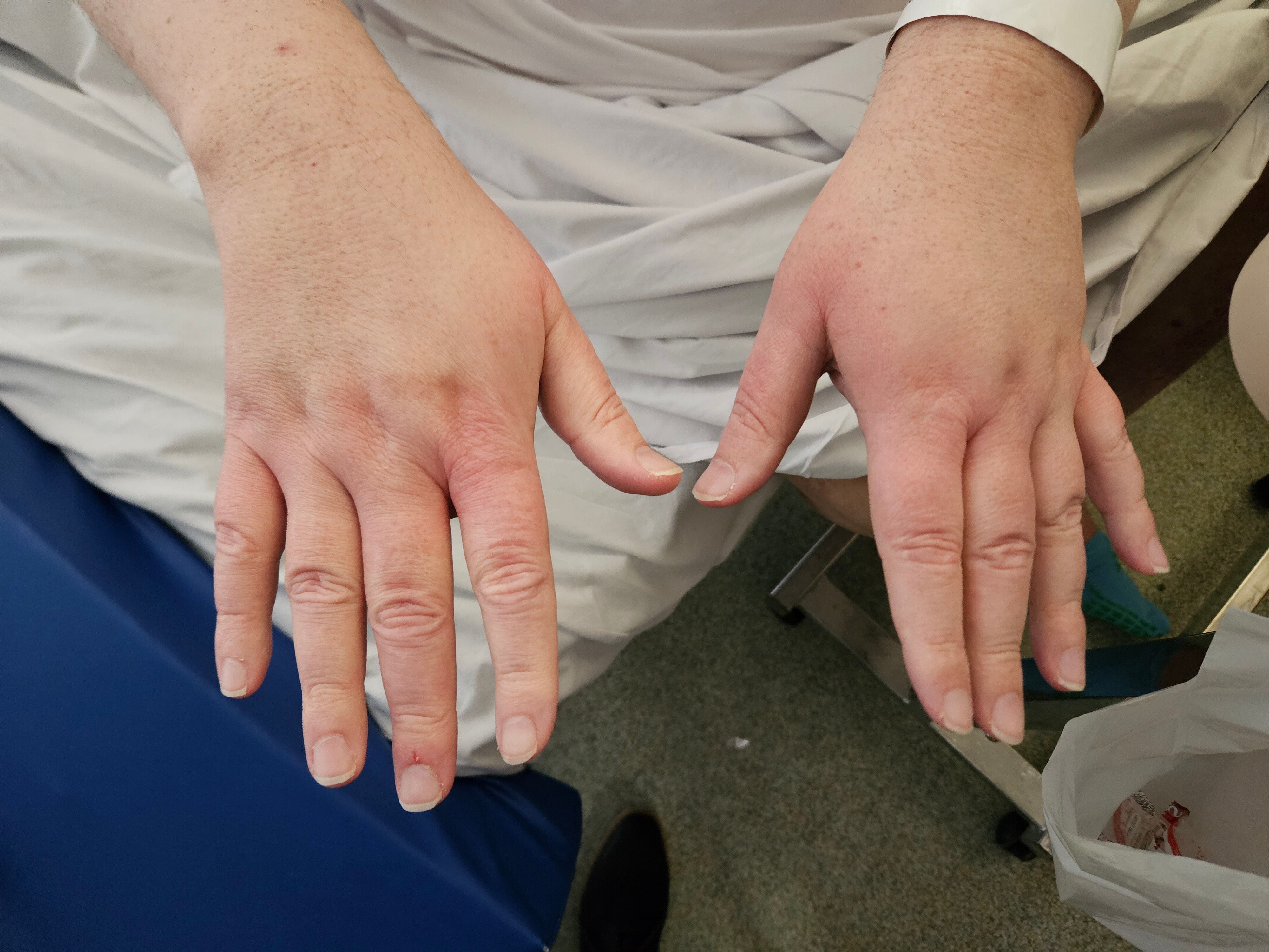 Doctors discover case of scurvy in Western Australia, warn it is a 're ...
