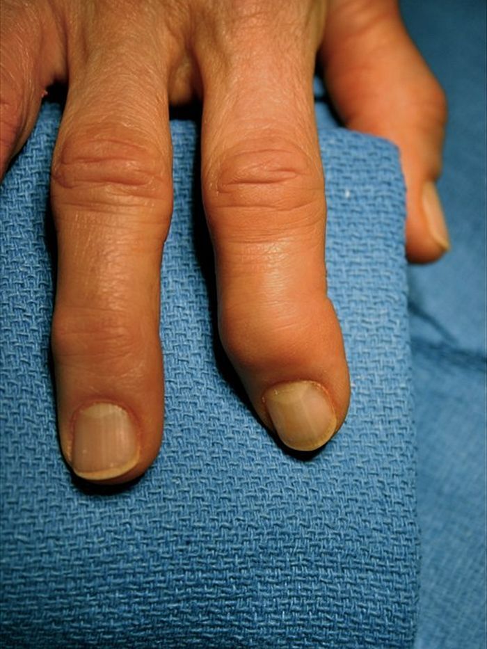 Depression and social isolation affecting arthritis patients - ABC listen