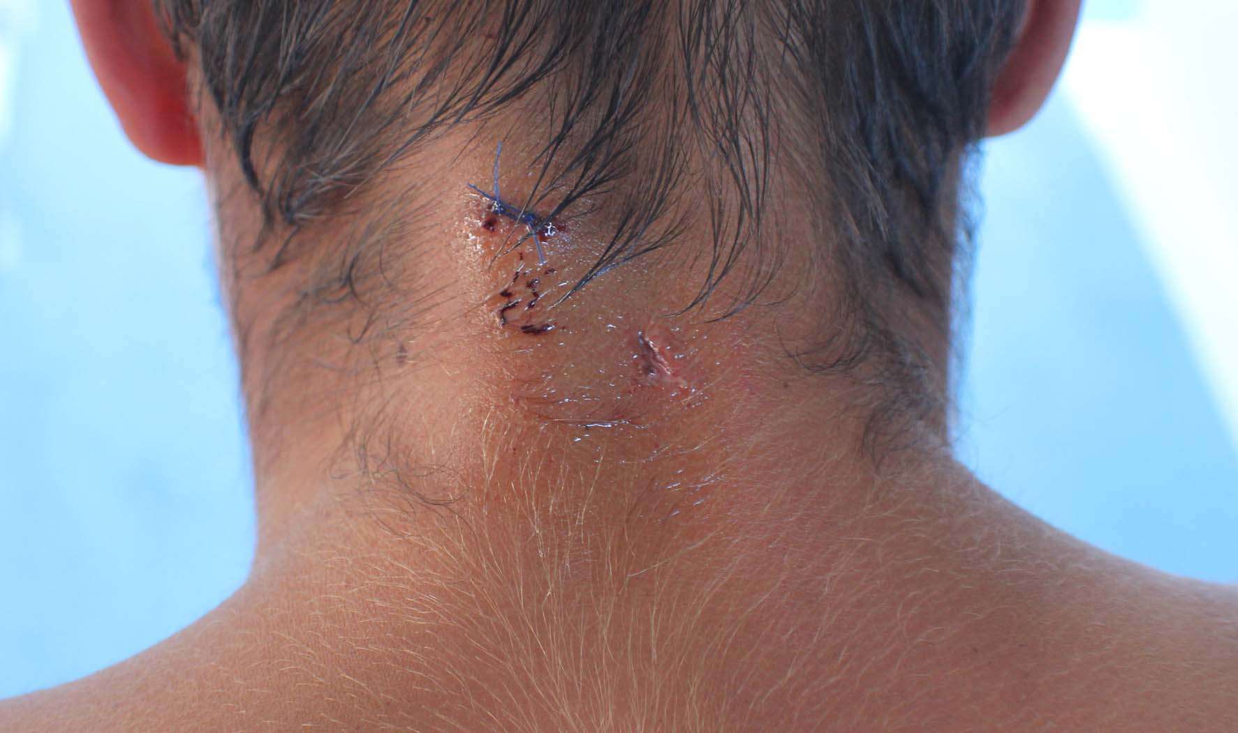 French fisherman survives croc attack - ABC News