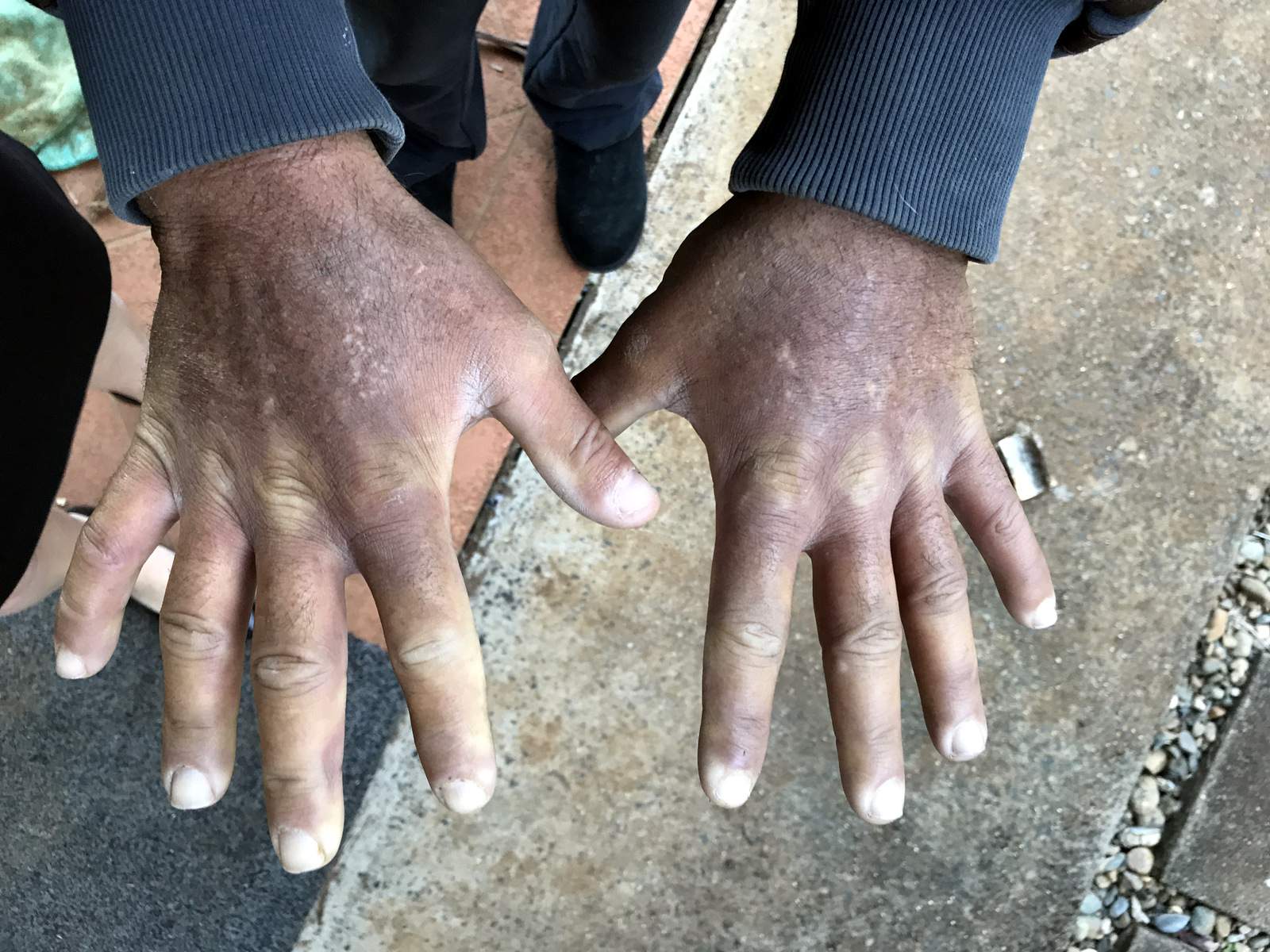 Scleroderma: the disease no-one knows about - ABC listen